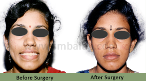 Upper Jaw Protrusion | Jaw Deformity Correction | Orthognathic Surgery