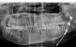 Stages of Distraction | Distraction Osteogenesis | Cranio-maxillofacial ...