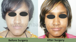 Lower jaw protrusion | Orthognathic Surgery | Corrective Jaw Surgery