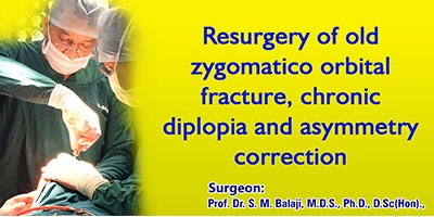 Zygomatico orbital fracture, chronic diplopia and asymmetry correction