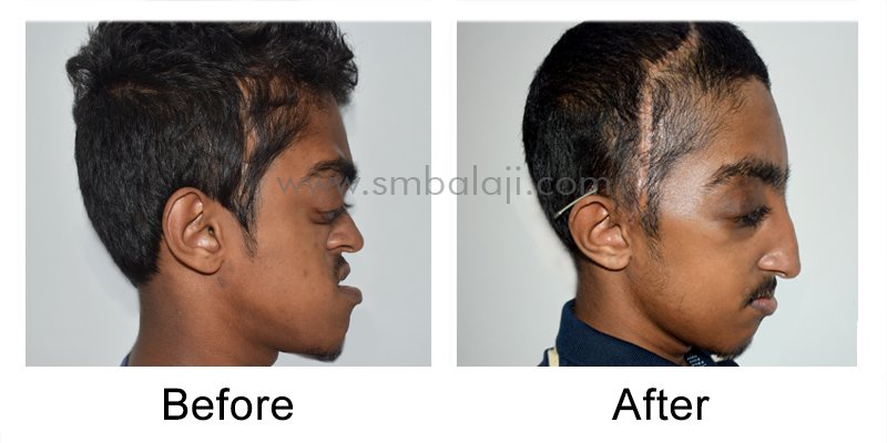 Crouzon Syndrome Before And After