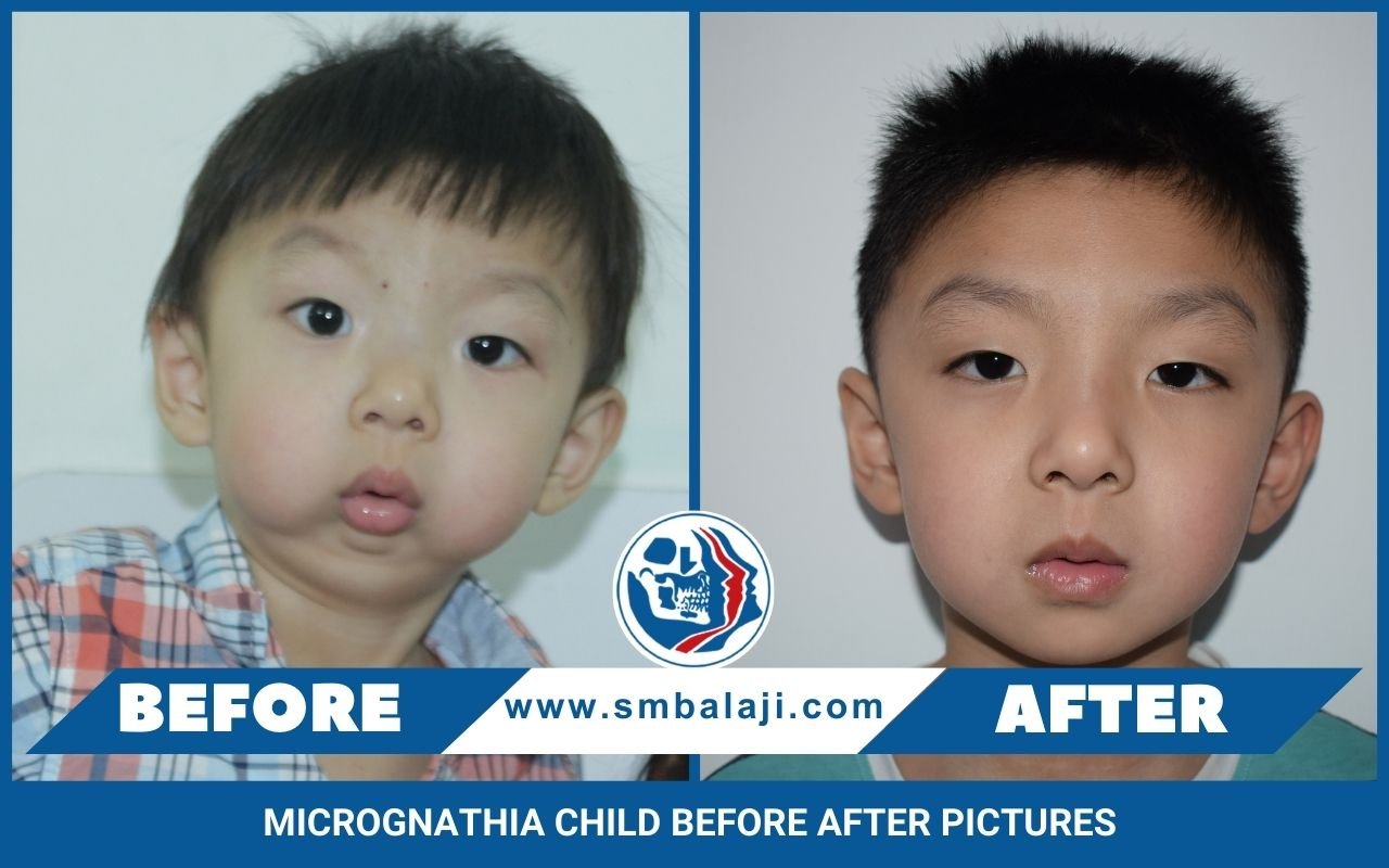 TMJ Growth Defects | TMJ (Temporomandibular joint) | Balaji Dental