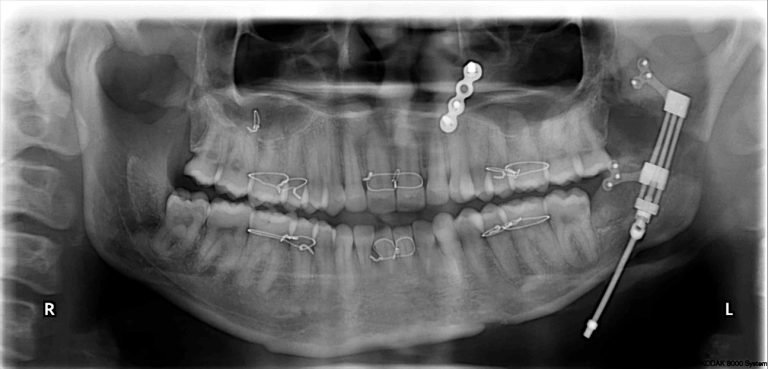 Stages of Distraction Osteogenesis, Cranio-maxillofacial surgery