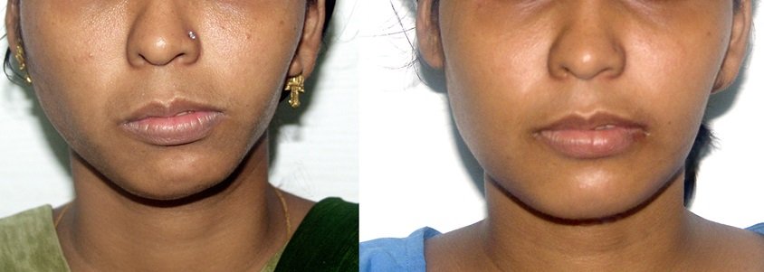 Stages of Distraction Osteogenesis, Cranio-maxillofacial surgery