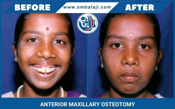 Anterior Maxillary Osteotomy: A Surgical Solution for Upper Jaw Prognathism
