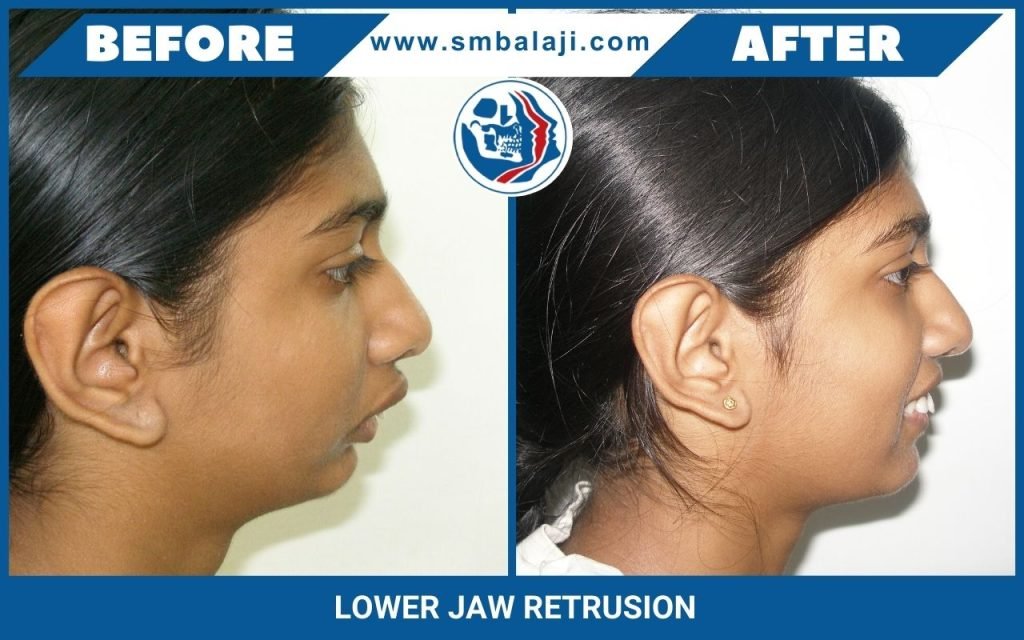 Lower Jaw Retrusion, Corrective Jaw Surgery Cosmetic Surgery