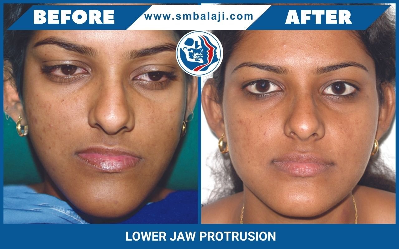 Lower jaw protrusion, Orthognathic Surgery, Corrective Jaw Surgery