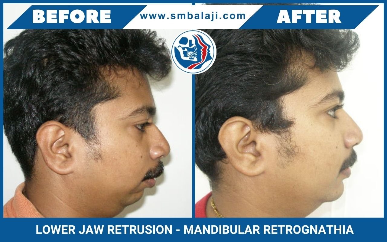 Lower Jaw Retrusion, Corrective Jaw Surgery Cosmetic Surgery
