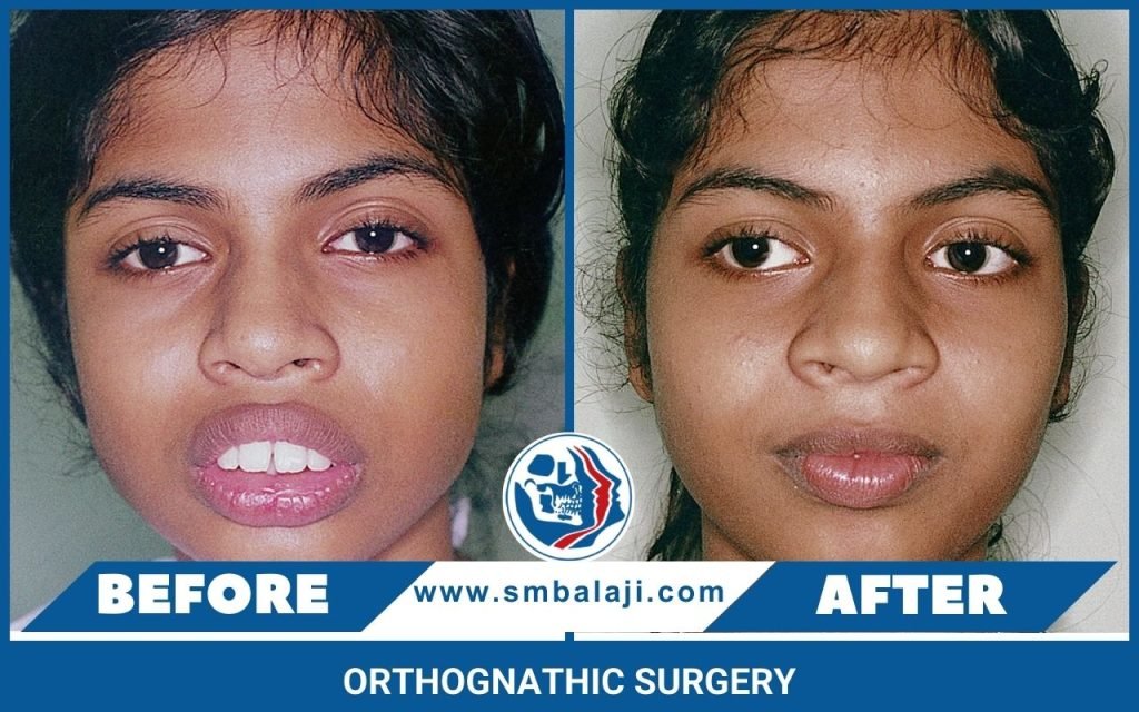 Upper Jaw Protrusion | Jaw Deformity Correction | Orthognathic Surgery