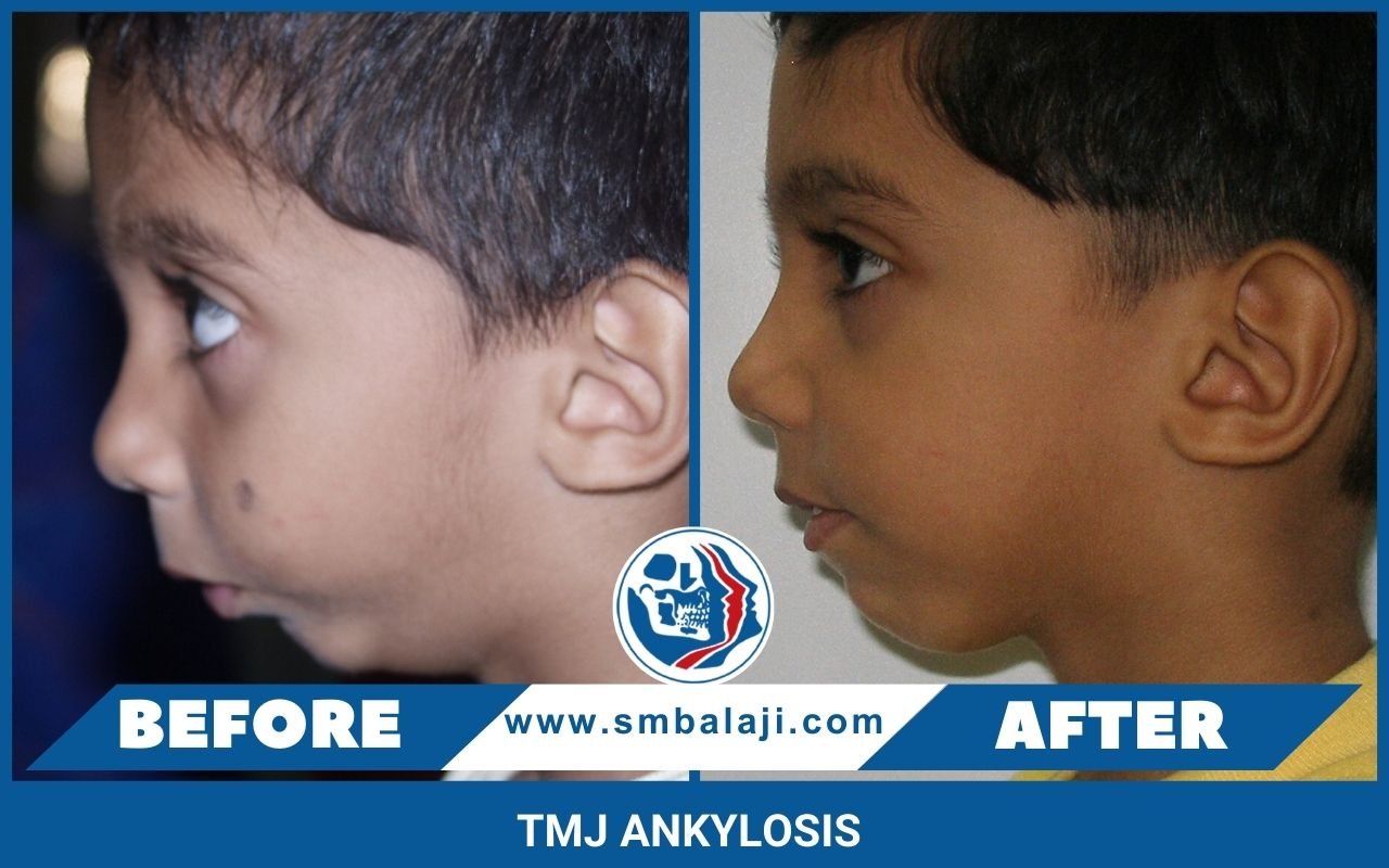 TMJ Ankylosis and Restoring Jaw Function