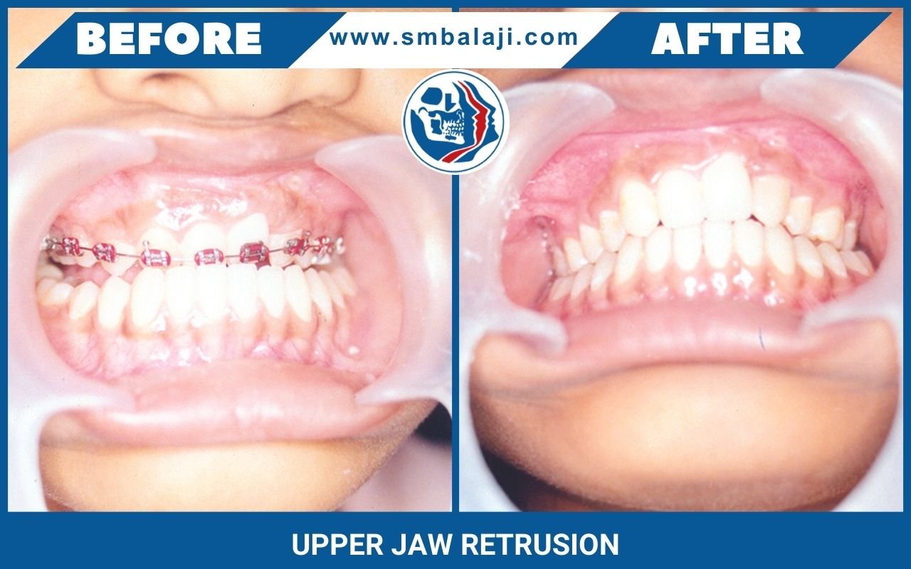 Upper Jaw Retrusion: Causes, Symptoms, and Treatment Options