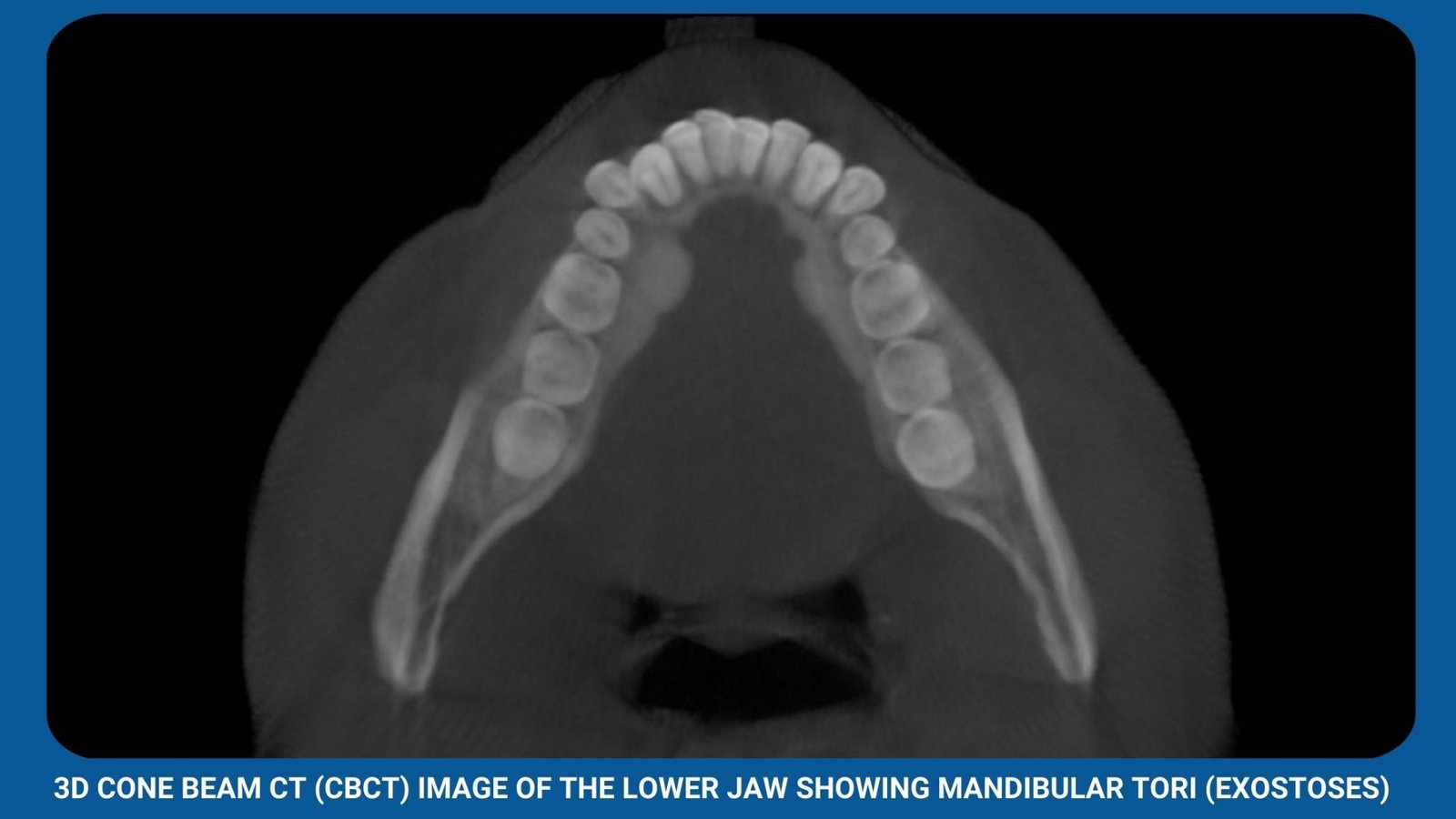 PRE-PROSTHETIC SURGERY, DENTOALVEOLAR SURGERY
