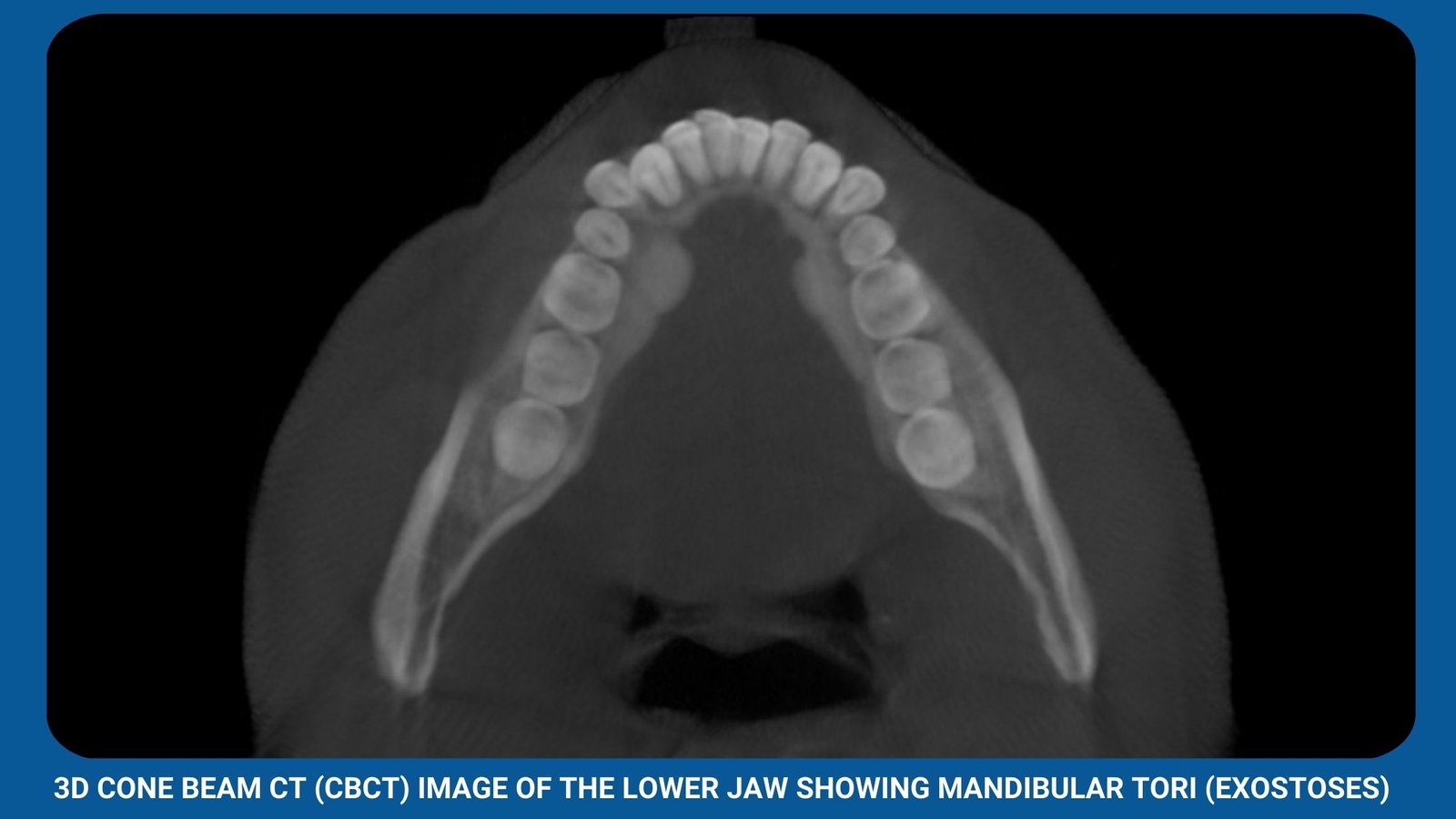 PRE-PROSTHETIC SURGERY, DENTOALVEOLAR SURGERY