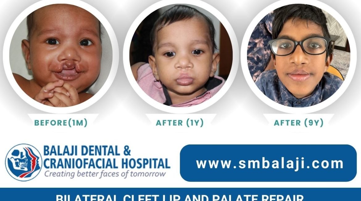 Bilateral Cleft Lip and Palate Repair | Balaji Dental and Craniofacial ...