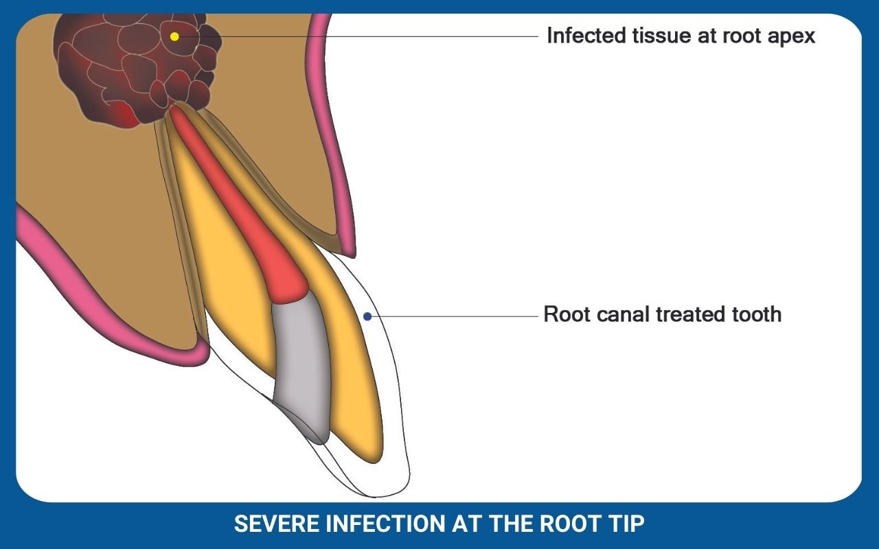 Apicoectomy, Surgical Endodontic Procedure