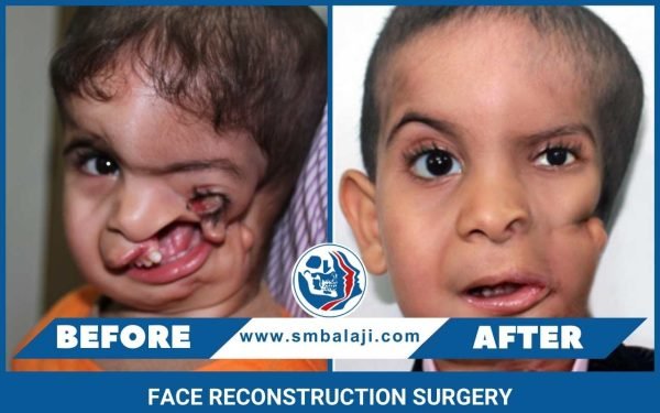 Face Reconstruction Surgery, Cranio maxillofacial Surgery in India