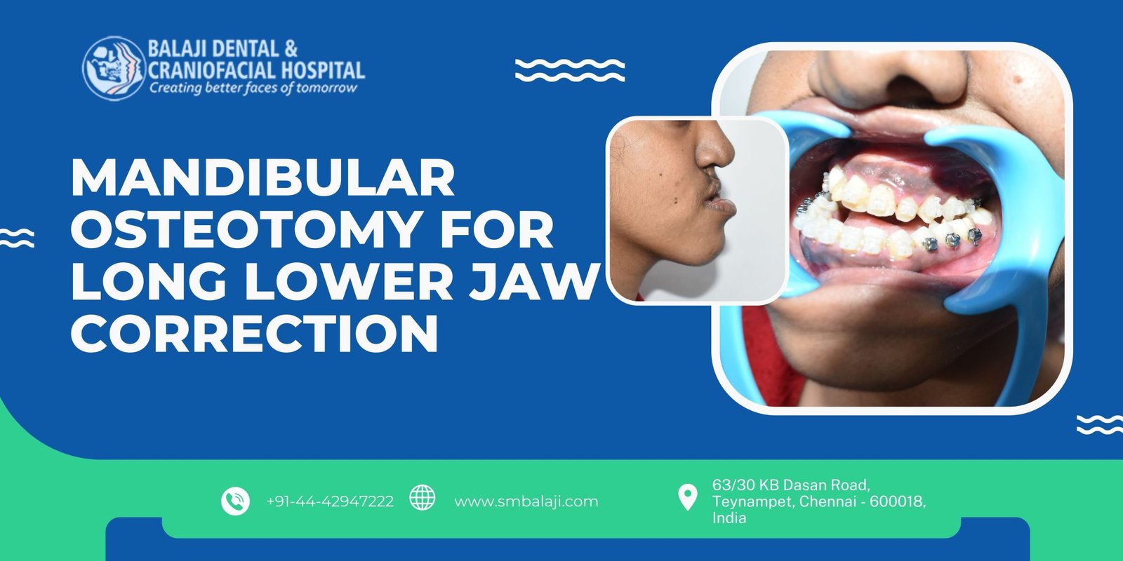 Mandibular Osteotomy , Maxillary and Mandibular Osteotomy Before ...